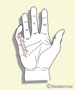 Esempio di incisione cutanea - Dr. Frank NienstedtDr. Frank Nienstedt